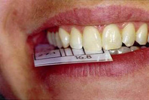 Golden Proportions in Teeth | Golden Mean Gauge