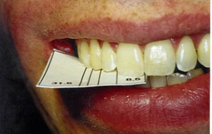 Golden Proportions in Teeth | Golden Mean Gauge